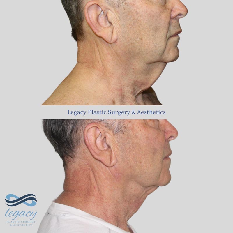 Lift & Tighten Facial Contours with FaceTite® in Exton, PA - Legacy ...